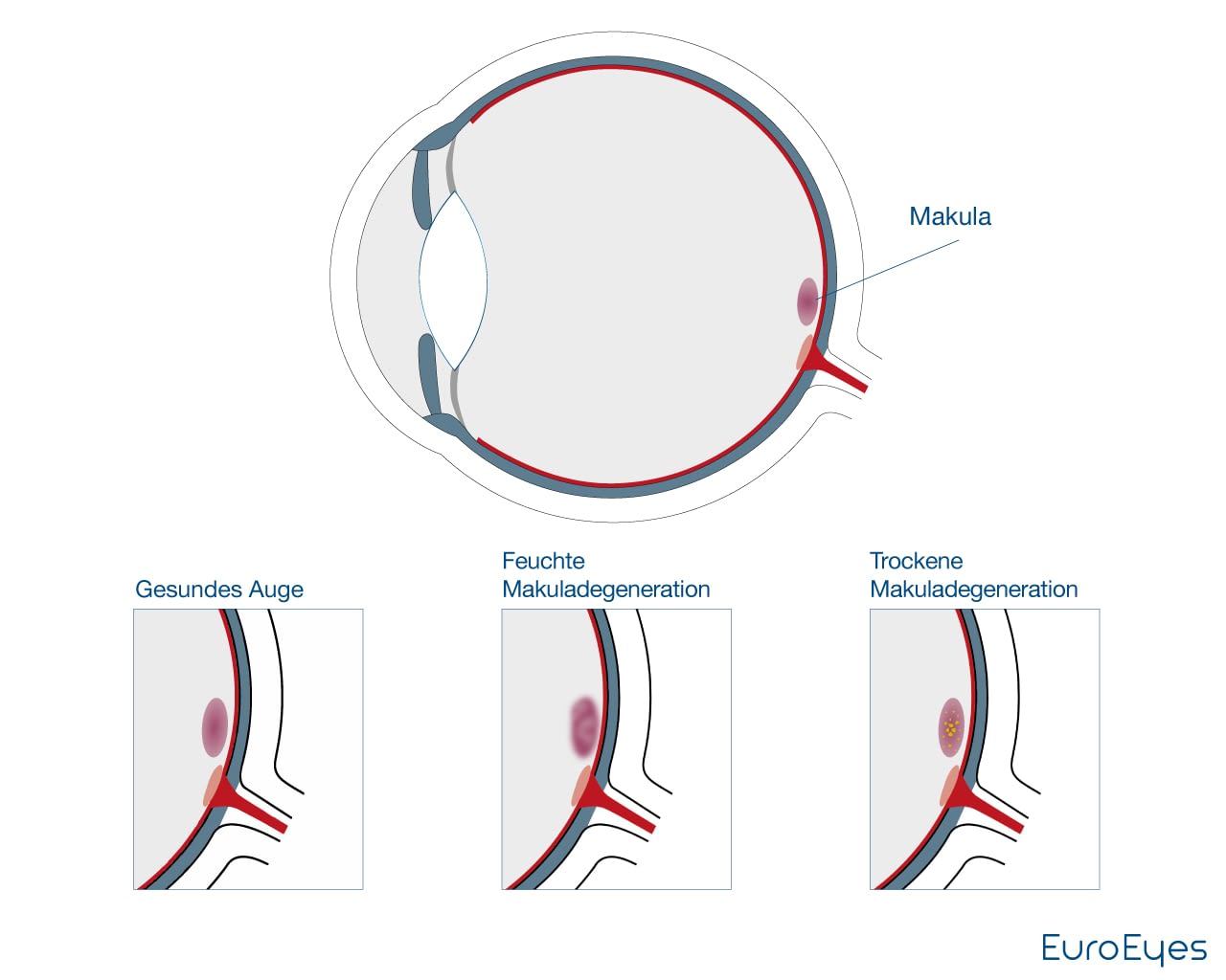 Makuladegeneration (AMD) - euroeyes.de