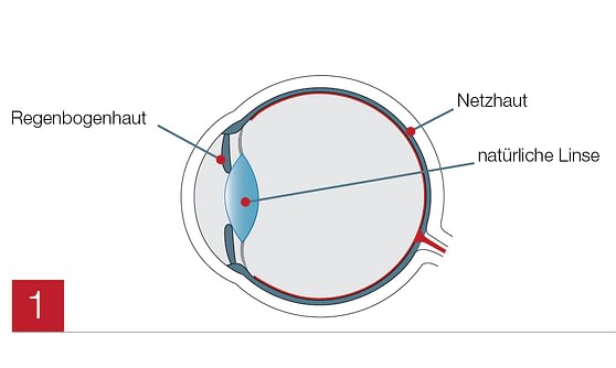 Multifokallinsen Implantation: Die Alternative zur Gleitsichtbrille ...