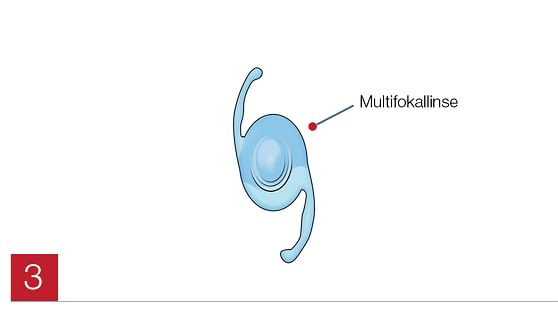Multifokallinsen Implantation: Die Alternative zur Gleitsichtbrille ...
